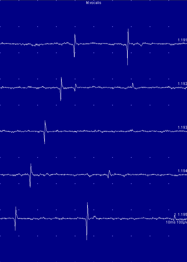 Pathologic Spontaneous Activity – Laryngeal Electromyography